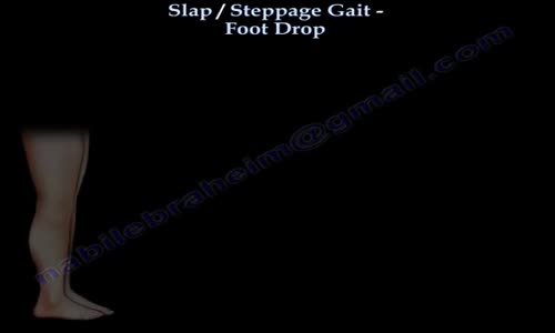 Slap gait , Steppage Gait . Foot Drop Everything You Need To Know Dr. Nabil Ebraheim
