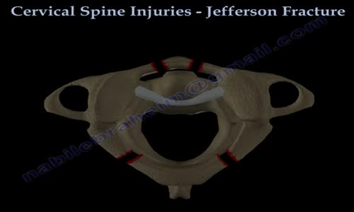 Cervical Spine Injuries Jefferson Fracture Everything You Need To Know ...