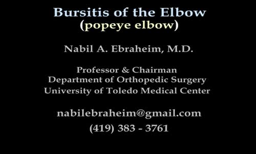 Bursitis Elbow Olecranon Popeye Elbow Everything You Need To Know Dr ...