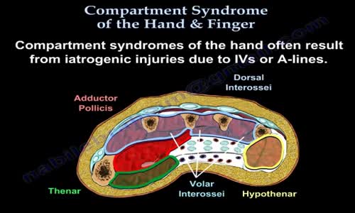 Compartment Syndrome Of The Hand & Finger Everything You Need To Know ...