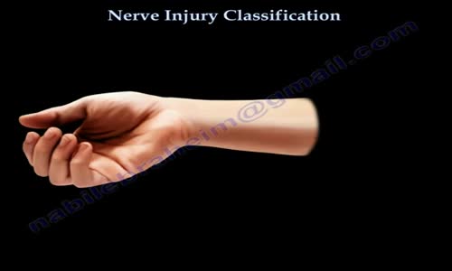 Nerve Injury ,types . Nerve recovery Everything You Need To Know Dr ...