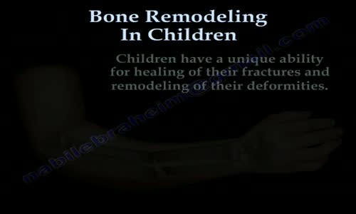 Fractures and Bone Remodeling In Children Everything You Need To Know ...