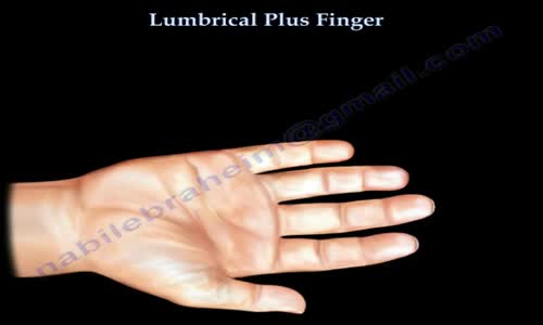 Lumbrical Plus Finger Everything You Need To Know Dr. Nabil Ebraheim