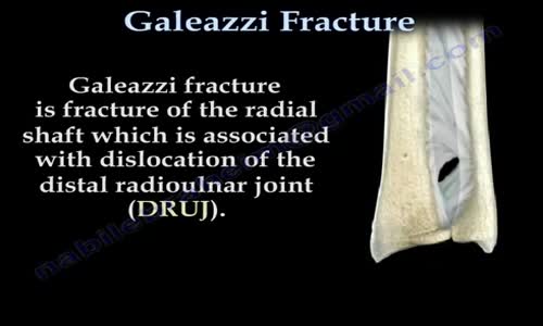 Galeazzi Fracture Everything You Need To Know Dr. Nabil Ebraheim