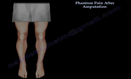 Phantom Pain Amputation Everything You Need To Know Dr. Nabil Ebraheim