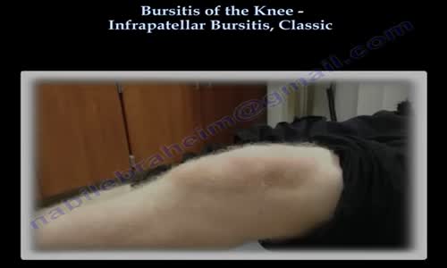 Knee Bursitis Infrapatellar Bursitis Classic Everything You Need To ...