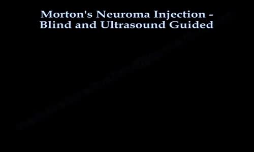 Mortons Neuroma Injection Everything You Need To Know Dr. Nabil Ebraheim