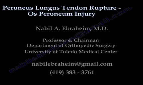 Peroneus Longus Tendon Rupture Os Peroneum Injury Everything You Need ...