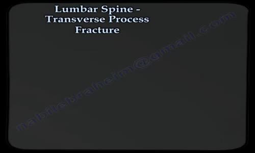 Lumbar Spine Transverse Process Fracture Everything You Need To Know Dr ...