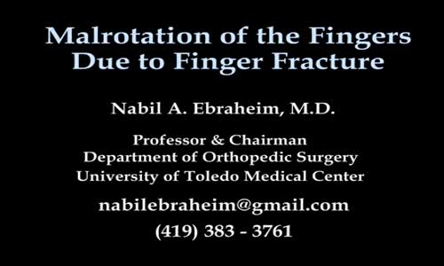 Finger Fractures Malrotation Of The Fingers Everything You Need To Know ...