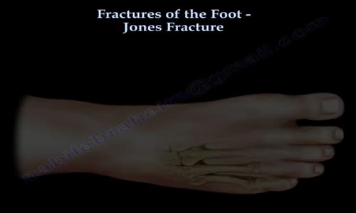 Jones Fracture,proximal fifth metatarsal Everything You Need To Know Dr ...