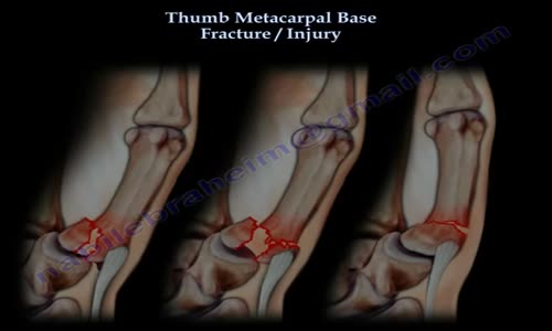 Thumb Metacarpal Base Fracture Injury Everything You Need To Know Dr ...
