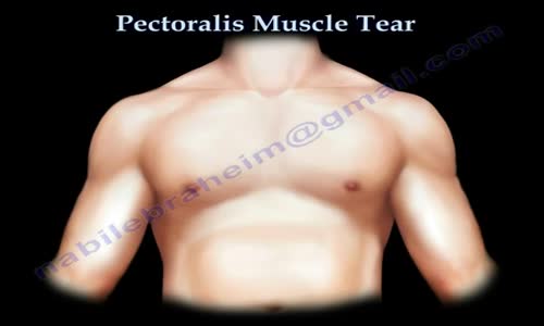 Pectoralis Muscle ,tendon Tear Everything You Need To Know Dr. Nabil ...