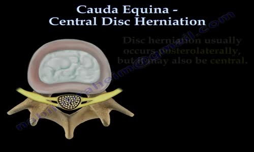 Cauda Equina, Central Disc Herniation Everything You Need To Know Dr ...