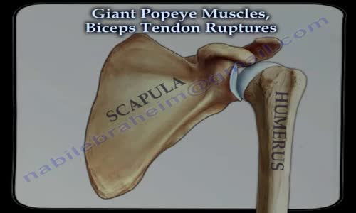 Giant Popeye Muscles Biceps Tendon Ruptures Everything You Need To Know ...