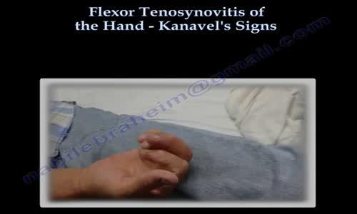 Flexor Tenosynovitis Of The Hand Kanavels Signs Everything You Need To ...