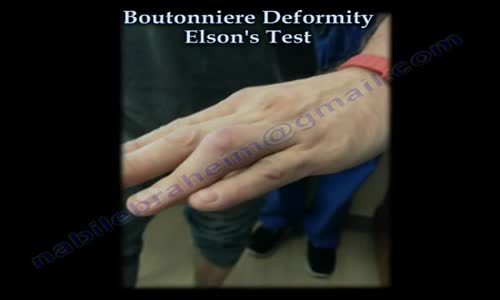Boutonniere Deformity Elsons Test Everything You Need To Know Dr. Nabil ...