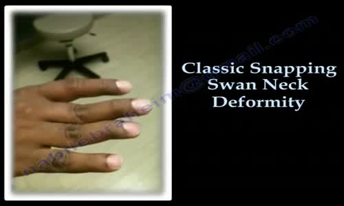 Swan Neck Deformity, Classic Snapping Everything You Need To Know Dr ...