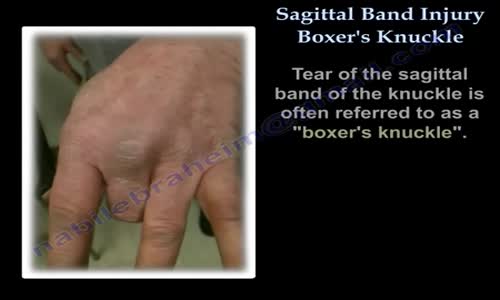 Sagittal Band Injury Boxers Knuckle Everything You Need To Know Dr ...
