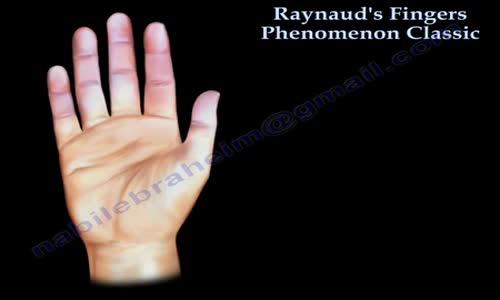 Raynauds Fingers Phenomenon classic Everything You Need To Know Dr ...