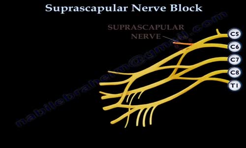 Shoulder Pain Injection Suprascapular Nerve Block Everything You Need ...