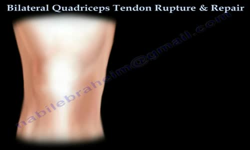 Bilateral Quadriceps Tendon Rupture & Repair Everything You Need To ...