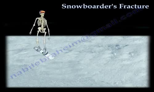 TALUS FRACTURE ,SNOWBOARDERS injury Everything You Need To Know Dr ...