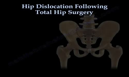 Hip Dislocation Following Total Hip replacement Everything You Need To ...