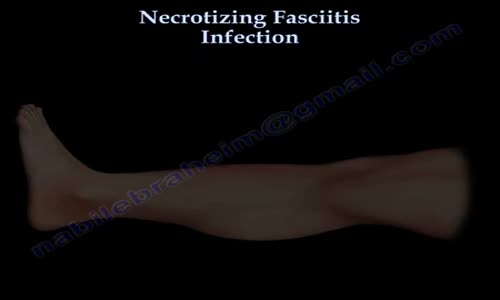 Necrotizing Fasciitis Infection Everything You Need To Know Dr. Nabil ...