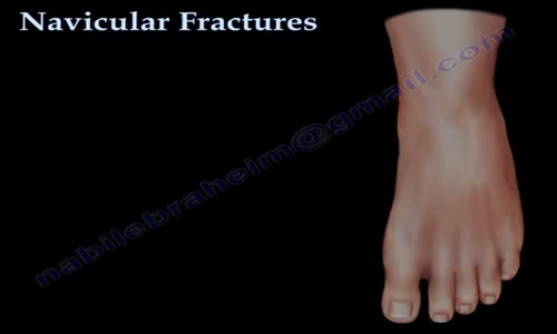 Navicular Fractures Everything You Need To Know Dr. Nabil Ebraheim