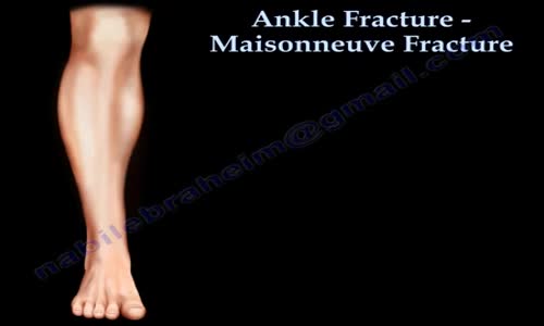 Ankle Fracture Maisonneuve Fracture Everything You Need To Know Dr ...