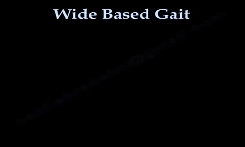 Wide Based Gait, Myelopathy Gait Everything You Need To Know Dr. Nabil ...