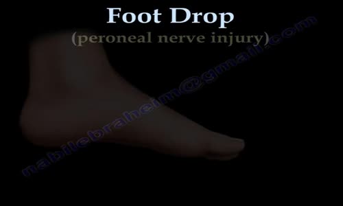 Foot Drop, Peroneal Nerve Injury Everything You Need To Know Dr. Nabil ...