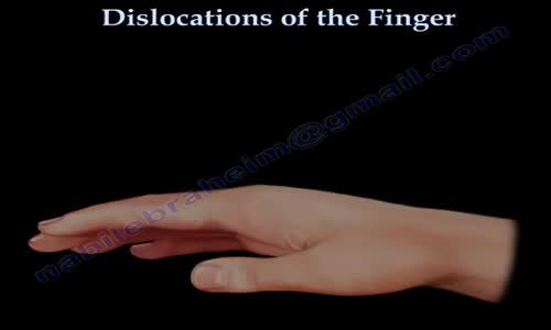 Dislocations Of The Finger Everything You Need To Know Dr. Nabil Ebraheim