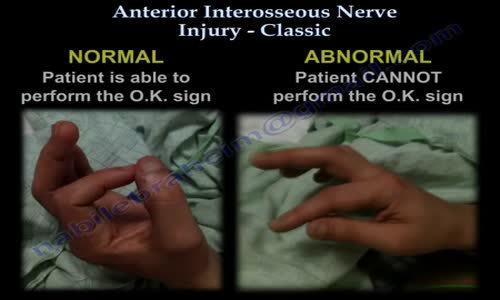 Anterior Interosseous Nerve Injury Classic Everything You Need To Know ...