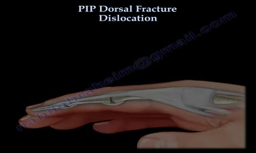 PIP Dorsal Fracture Dislocation Everything You Need To Know Dr. Nabil ...