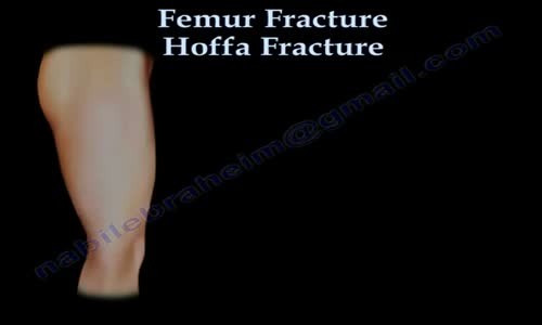 Hoffa Fracture Everything You Need To Know Dr. Nabil Ebraheim