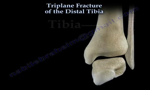 Triplane Fracture Of The Distal Tibia Everything You Need To Know Dr ...