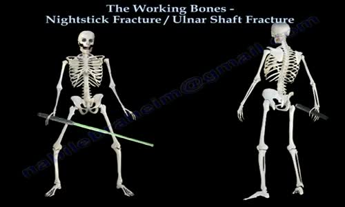 Nightstick Fracture , Ulnar Shaft fracture Everything You Need To Know ...