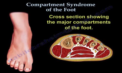 Foot Compartment Syndrome Everything You Need to Know Dr. Nabil Ebraheim