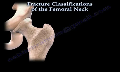 Femoral Neck Classifications Everything You Need To Know Dr. Nabil Ebraheim