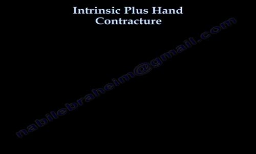 Intrinsic Plus Hand Contracture Everything You Need To Know Dr. Nabil ...