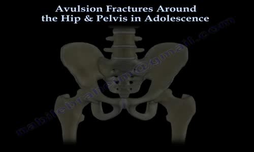 Avulsion Fractures Around The Hip In Adolescence Everything You Need To ...