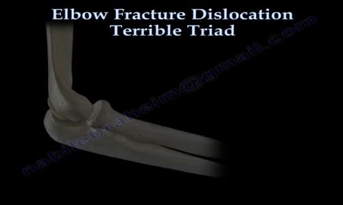 Elbow Fracture Dislocation Terrible Triad Everything You Need To Know ...