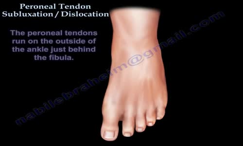 Peroneal Tendon Subluxation Dislocation Everything You Need To Know Dr ...