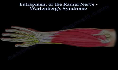Entrapment of Radial Nerve, Wartenbergs Syndrome Everything You Need To ...