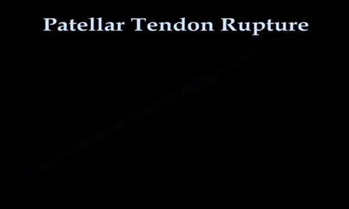 Patellar Tendon Rupture Everything You Need To Know Dr. Nabil Ebraheim