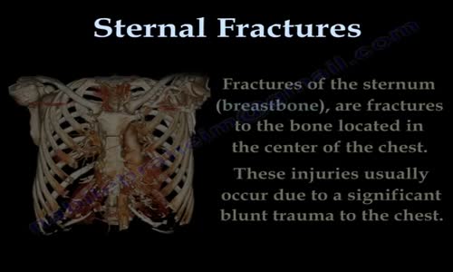 Sternal Fractures Everything You Need To Know Dr. Nabil Ebraheim