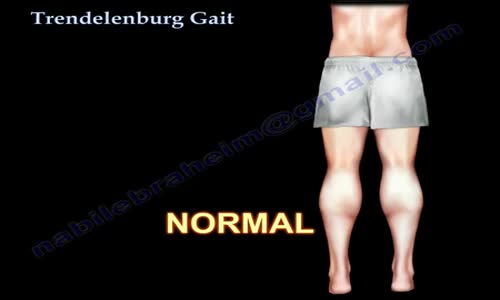 Trendelenburg Gait Everything You Need To Know Dr. Nabil Ebraheim