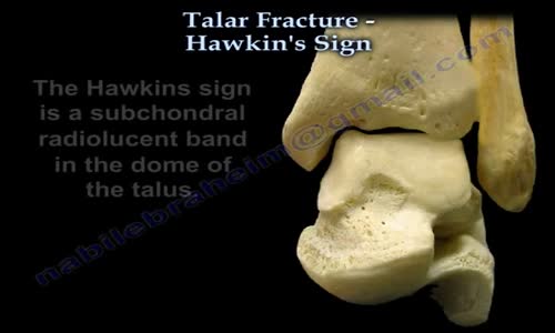 Talus Fracture , Hawkins Sign Everything You Need To Know Dr. Nabil ...